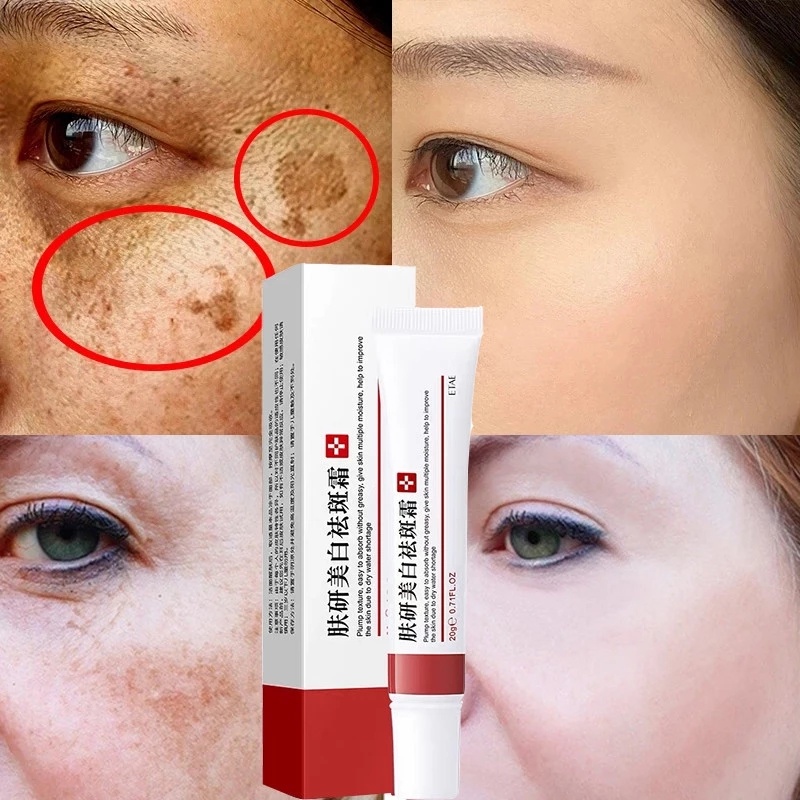 Crema De Pecas Blanqueadora Efectiva Eliminar Melasma Manchas Oscuras Melanina Hidratar Suavizar ...