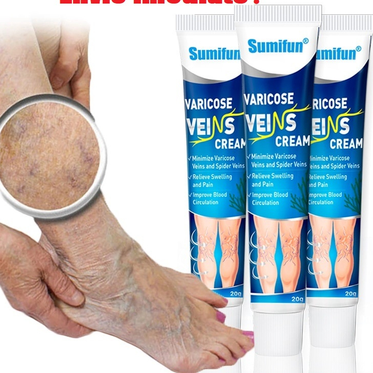 Tratamiento De Venas Varicosas Crema De Eliminación De Yeso Vasculitis ...