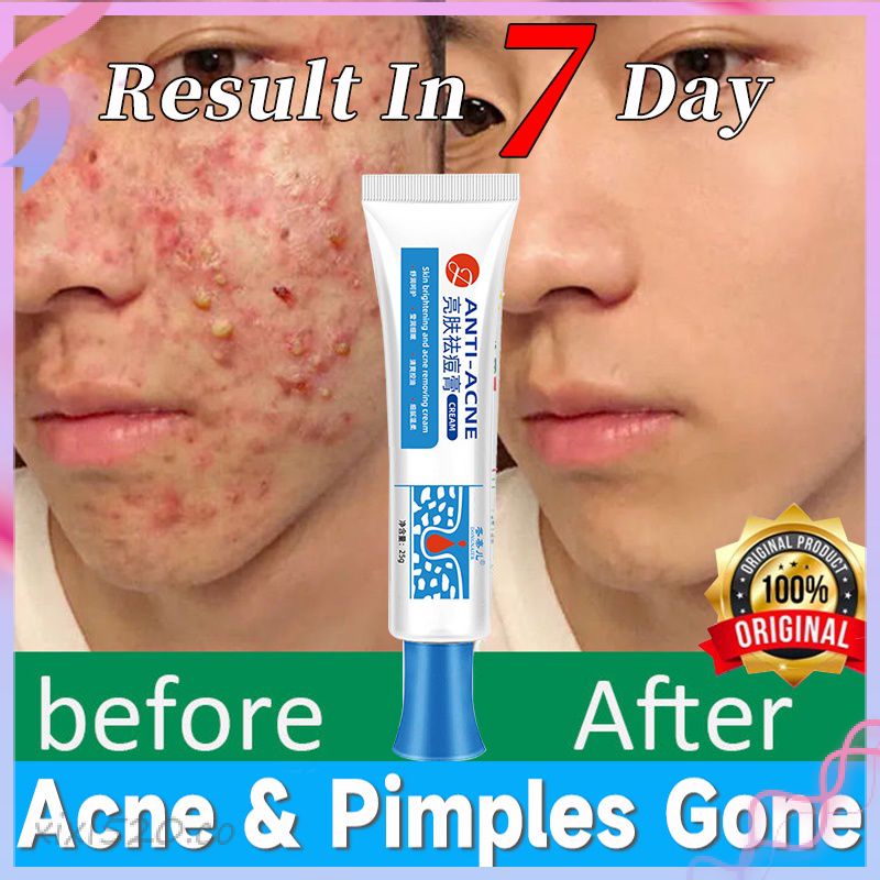 Crema para eliminar el acné Crema para eliminar marcas de espinillas Tratamiento para el acné ...